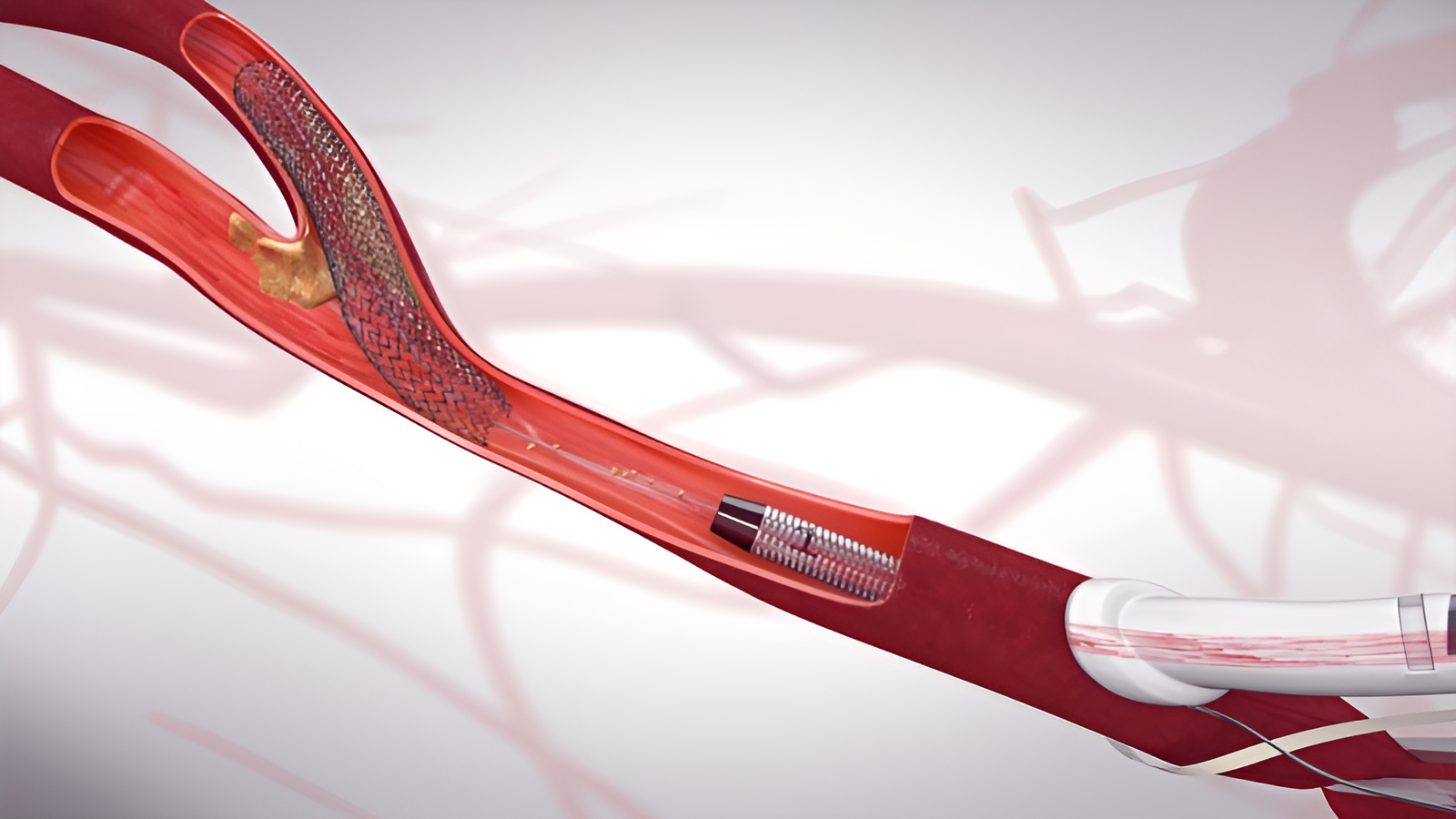 Preventing Strokes with TCAR: Revolutionary Treatment Now Available in ...
